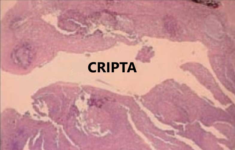 Cirurgia de amigdalas para caseos amigdalianos e mau halito